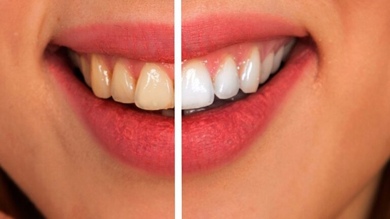 17 Remedios Caseros Para Blanquear Los Dientes Tratamientos Y Consejos